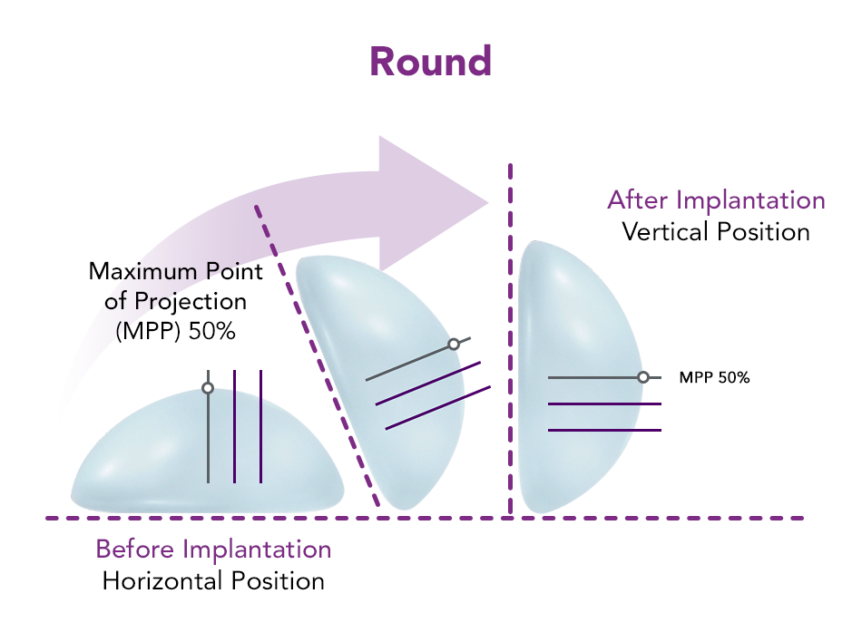 Asia's 5 Best Destinations for Breast Augmentation With Motiva Implants